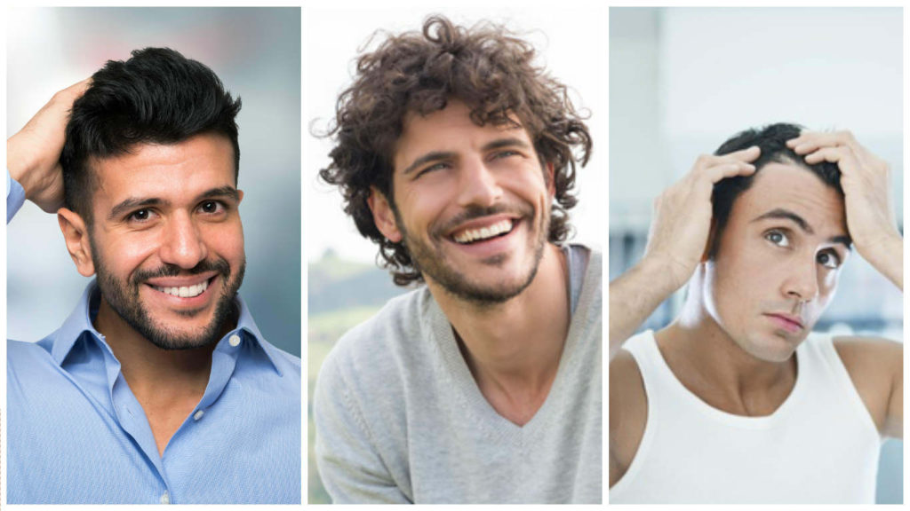 Injerto de pelo de Simeone - BonomédicoBlog